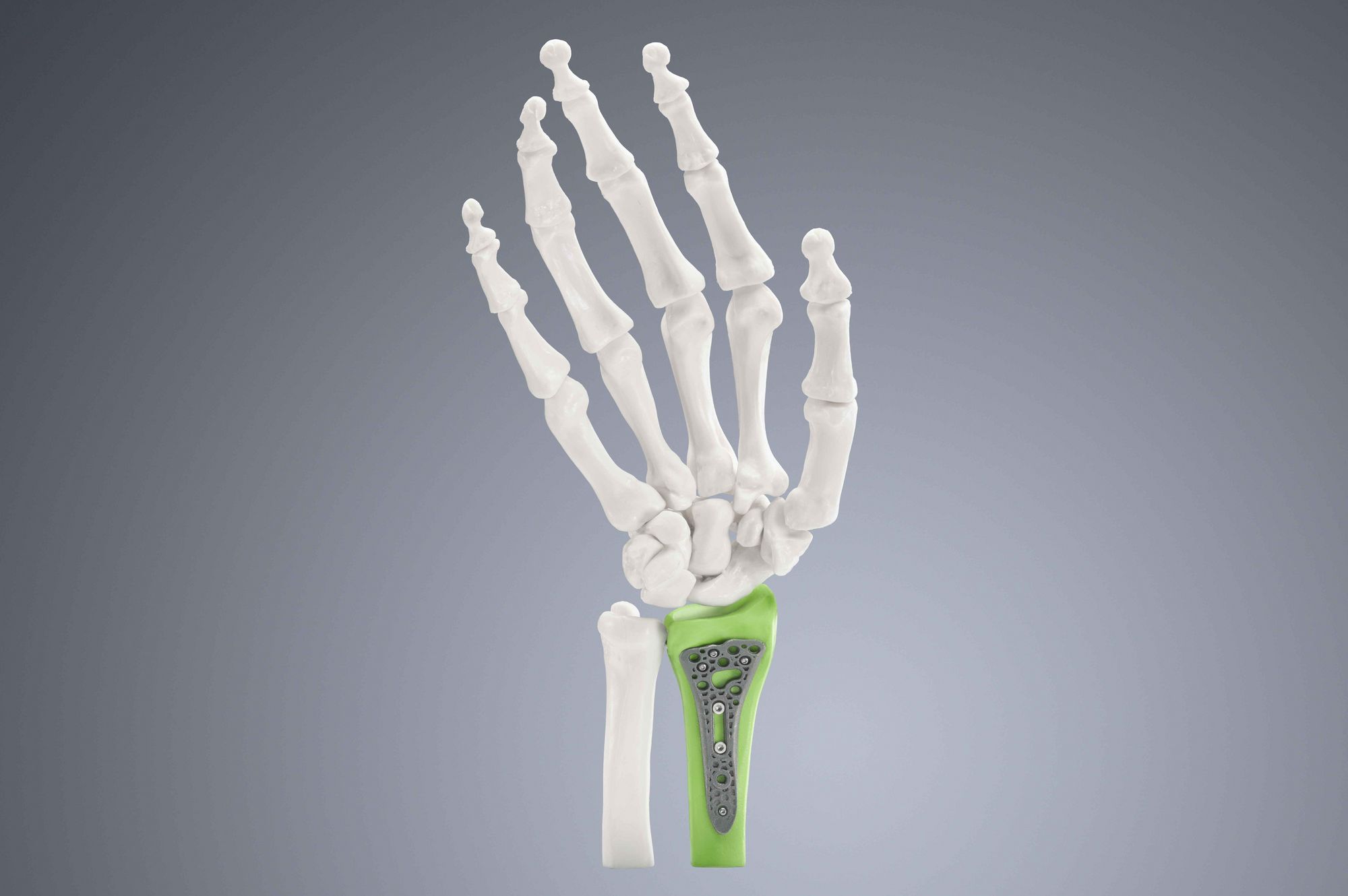 Wrist joint implant made of amorphous metal | TRUMPF