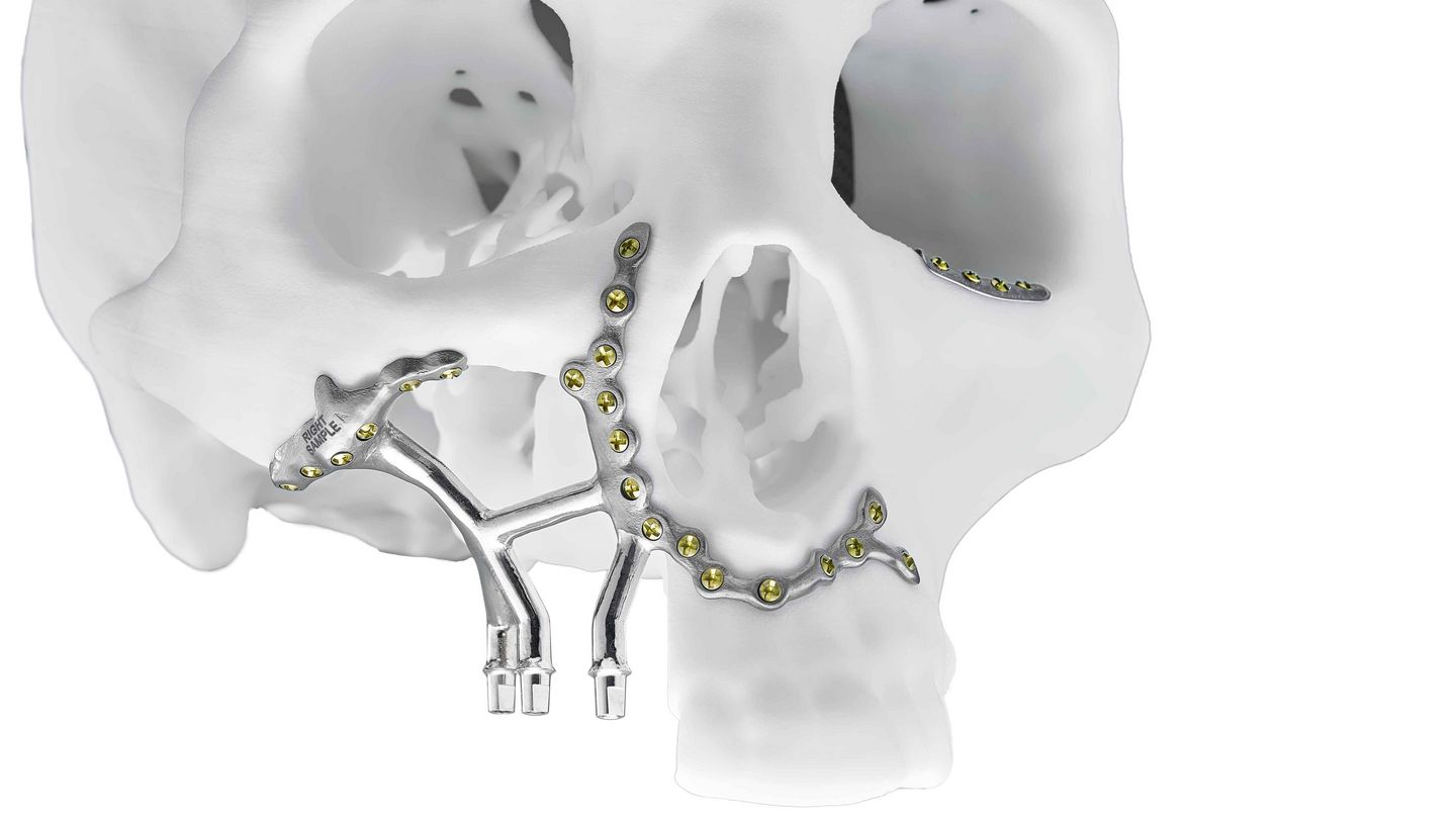 Use case: Additive manufacturing of CMF implants | TRUMPF