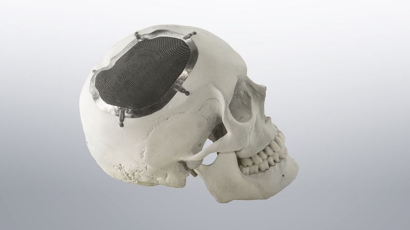 Laser production of medical devices | TRUMPF